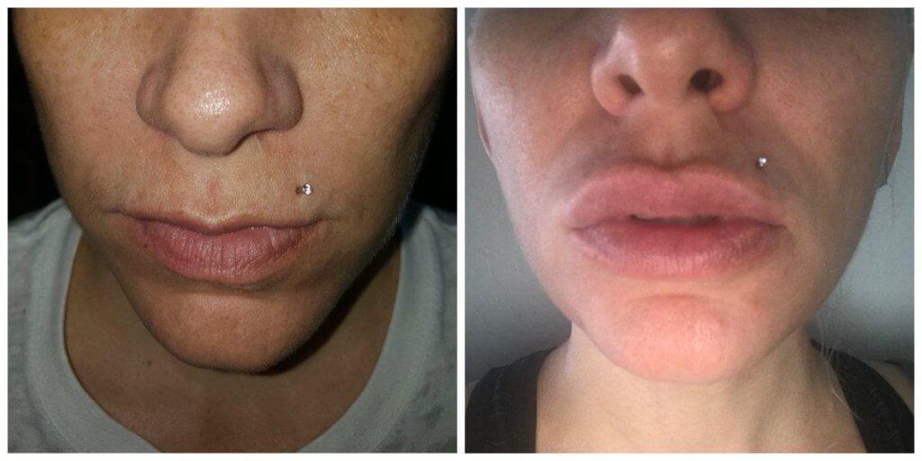 Kelly before and after Lip injections - Majestic Beauty Spa PLLC